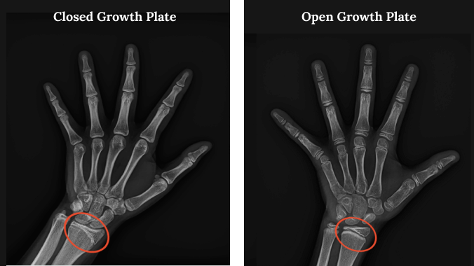 Growth Plate Evaluation for Children | HGH Kids Clinic